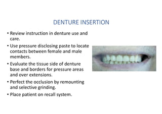 TOOTH SUPPORTED OVERDENTURES IN PROSTHODONTICS | PDF