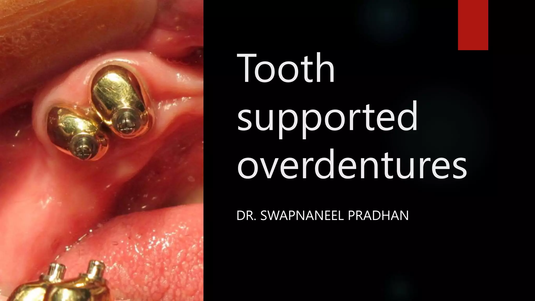 Tooth supported Overdentures | PPTX