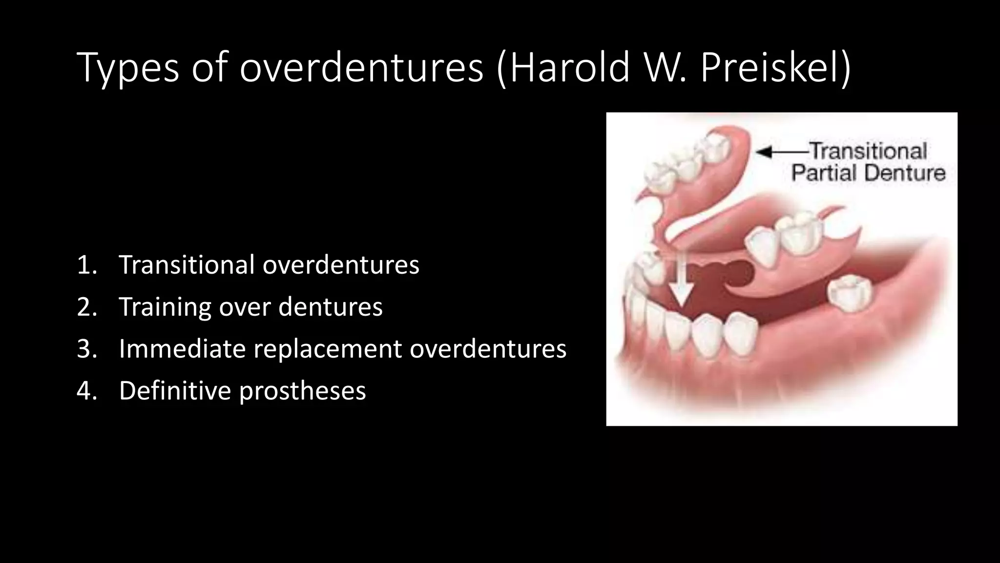Tooth supported Overdentures | PPTX