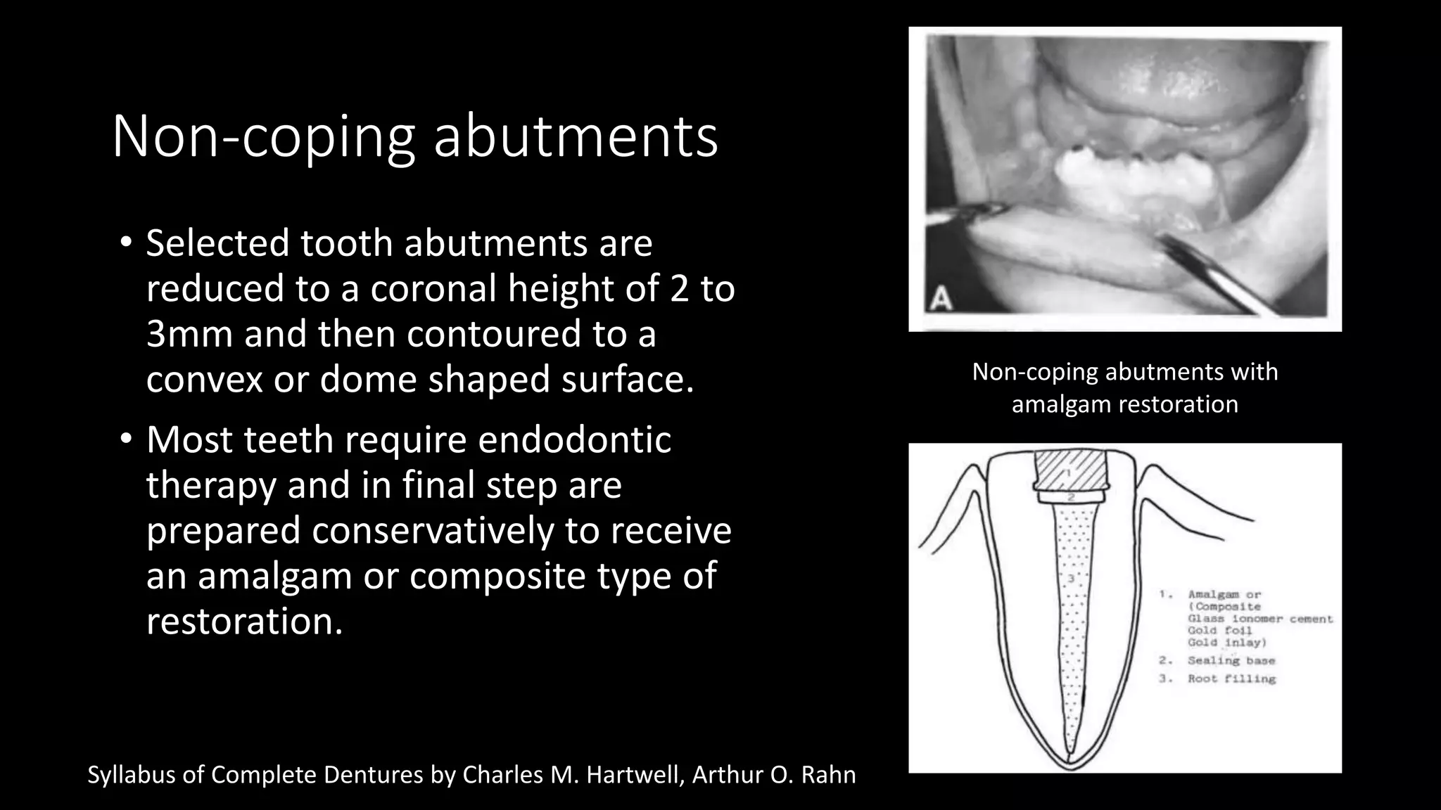 Tooth supported Overdentures | PPTX