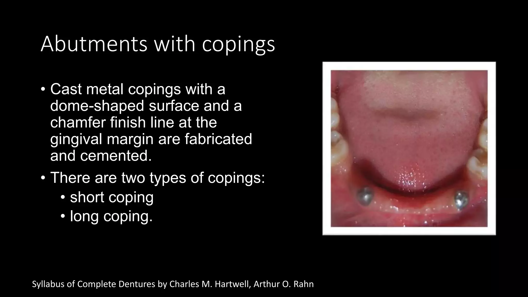 Tooth supported Overdentures | PPTX