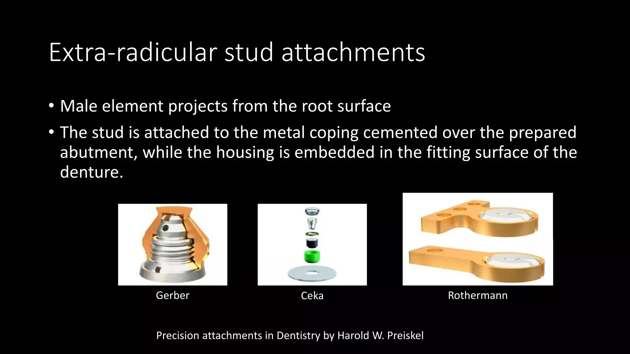 Tooth supported Overdentures | PPTX
