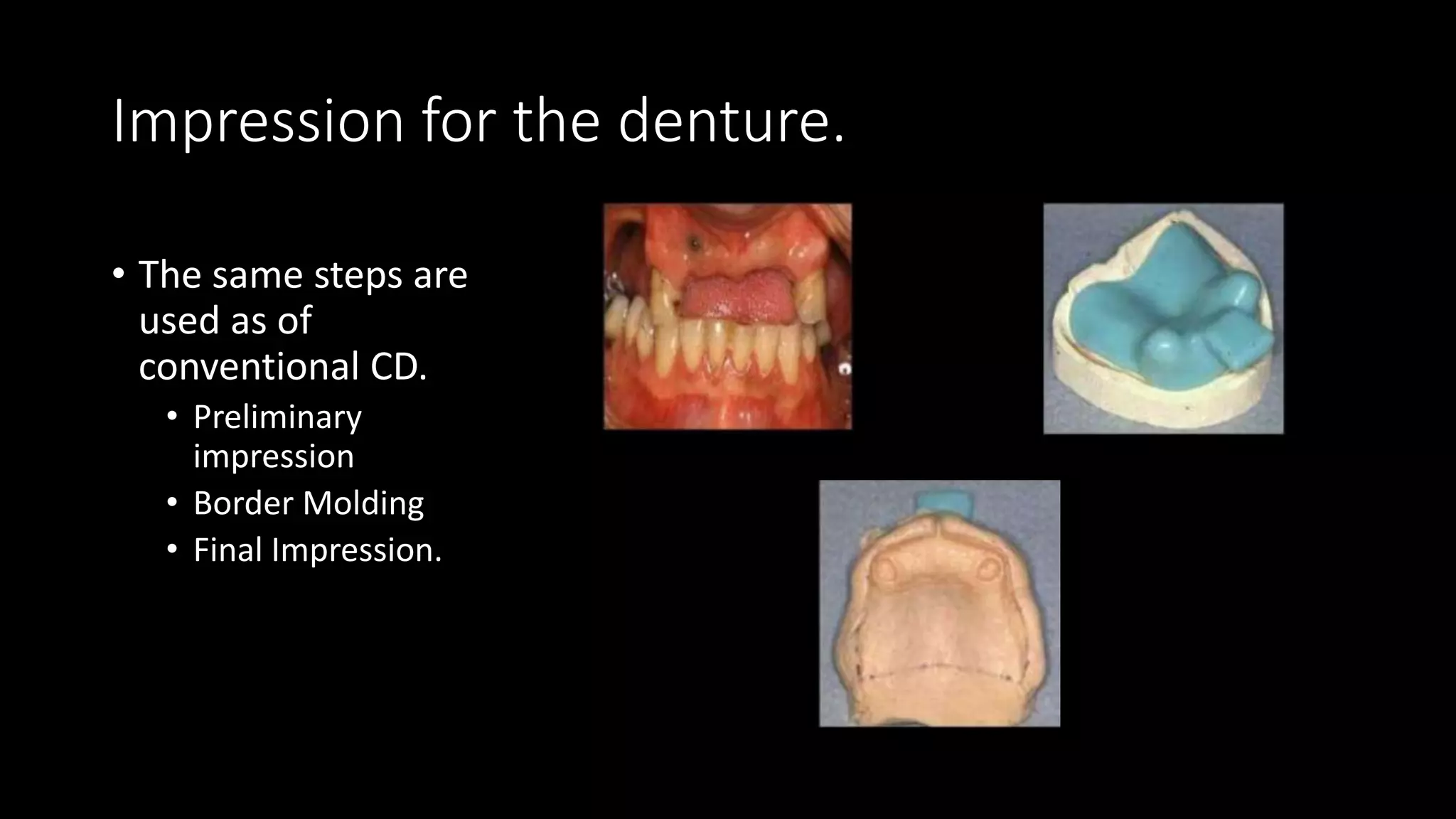 Tooth supported Overdentures | PPTX