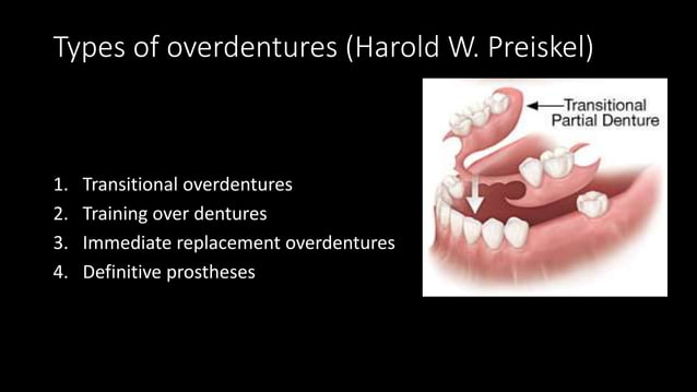 Tooth supported Overdentures | PPTX | Oral care | Personal Care