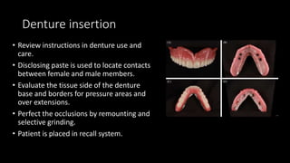 Tooth supported Overdentures | PPTX