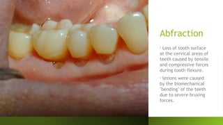 Tooth_Surface its a dental disease _Loss.pptx