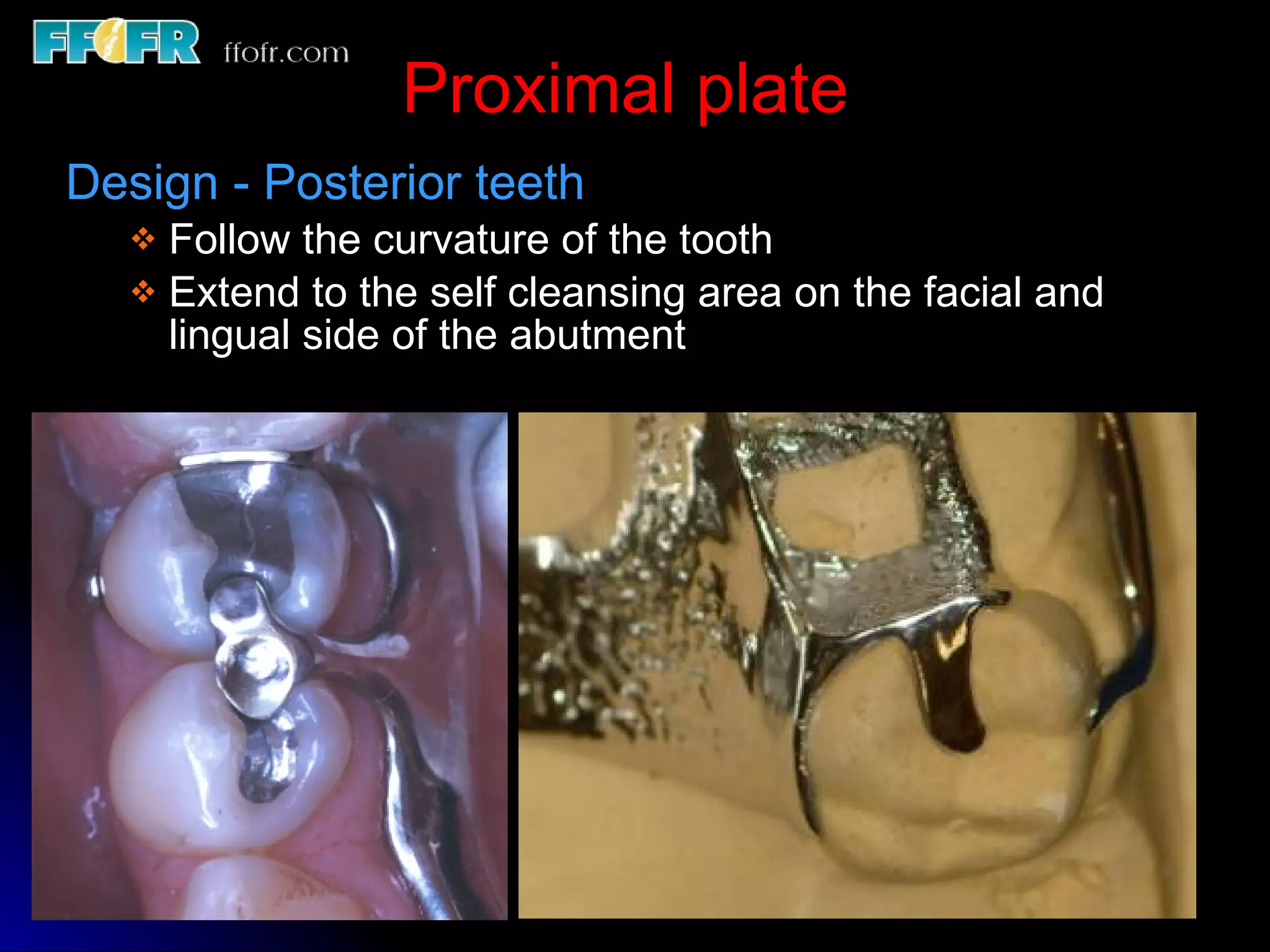 Tooth tissue junction, major and minor connectors | PPT