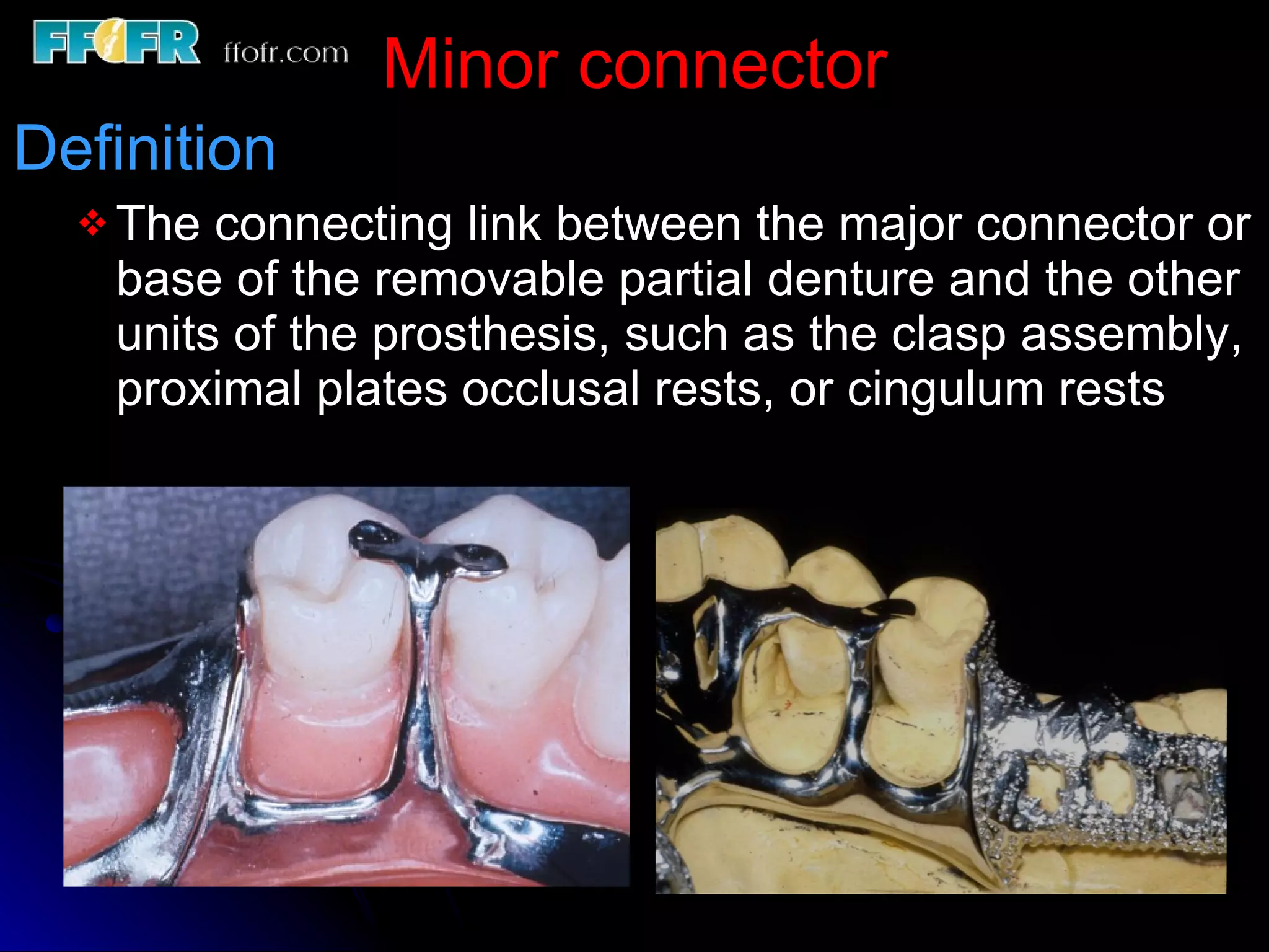 Tooth tissue junction, major and minor connectors | PPT