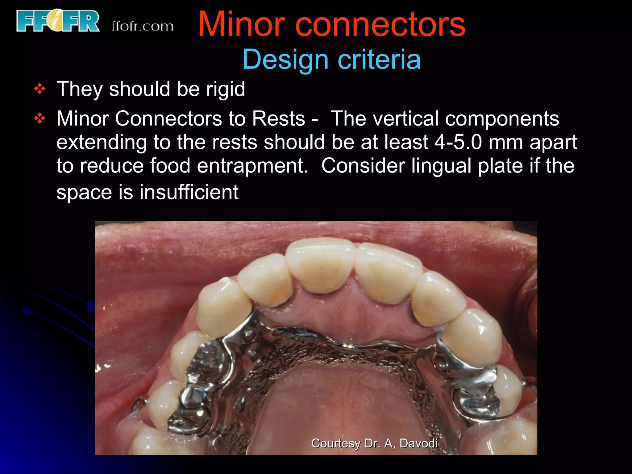 Tooth tissue junction, major and minor connectors | PPT
