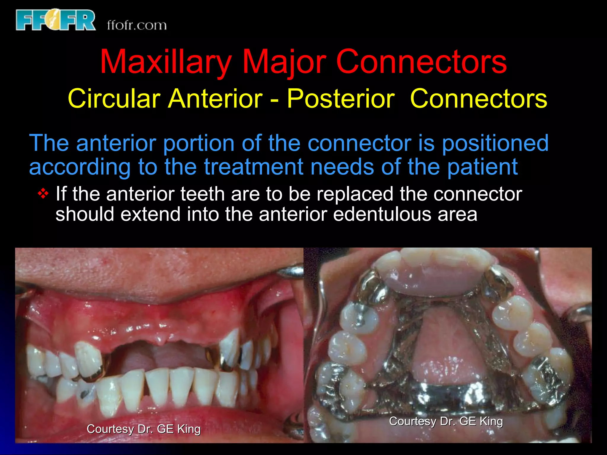 Tooth tissue junction, major and minor connectors | PPT