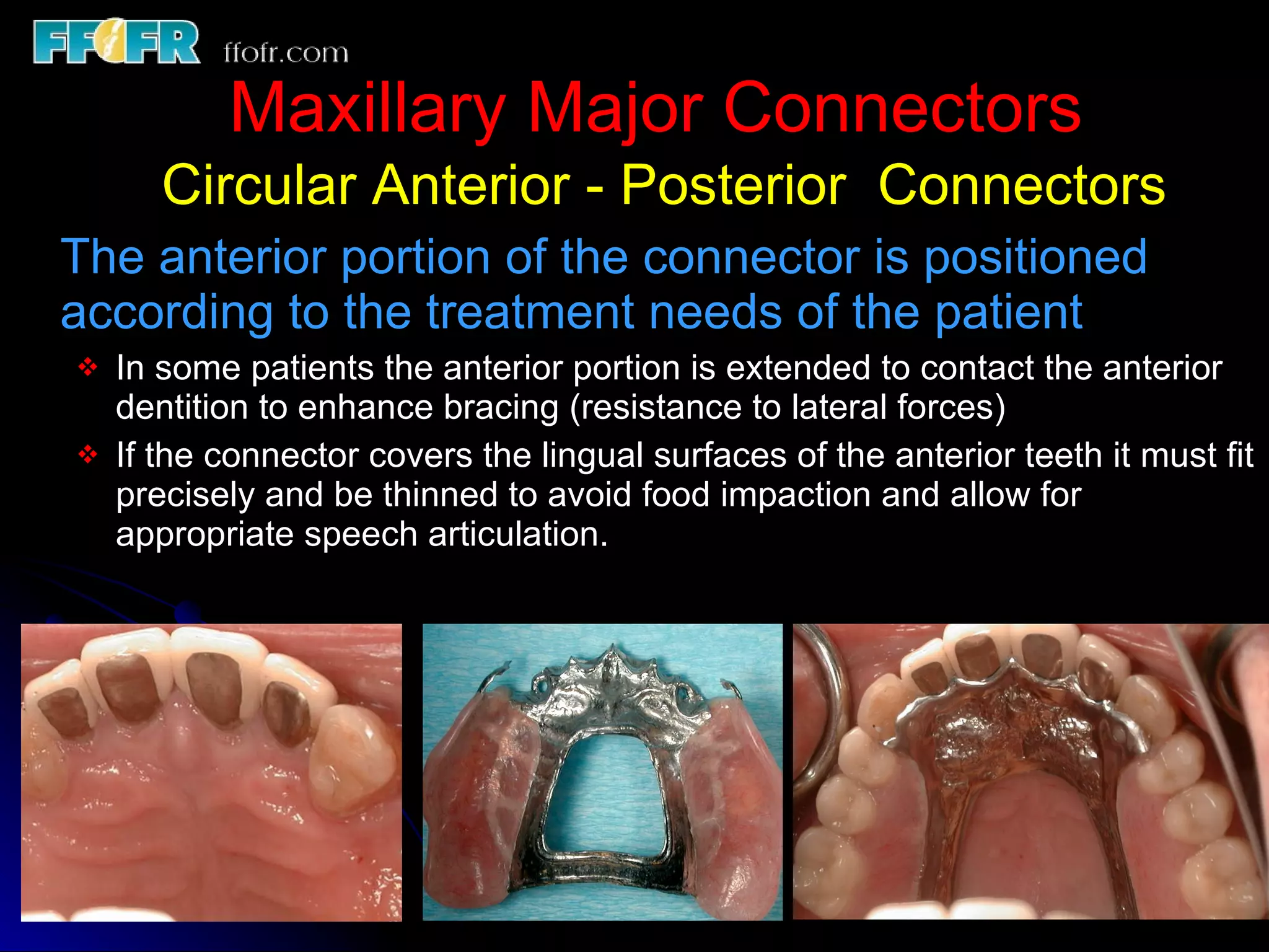 Tooth tissue junction, major and minor connectors | PPT