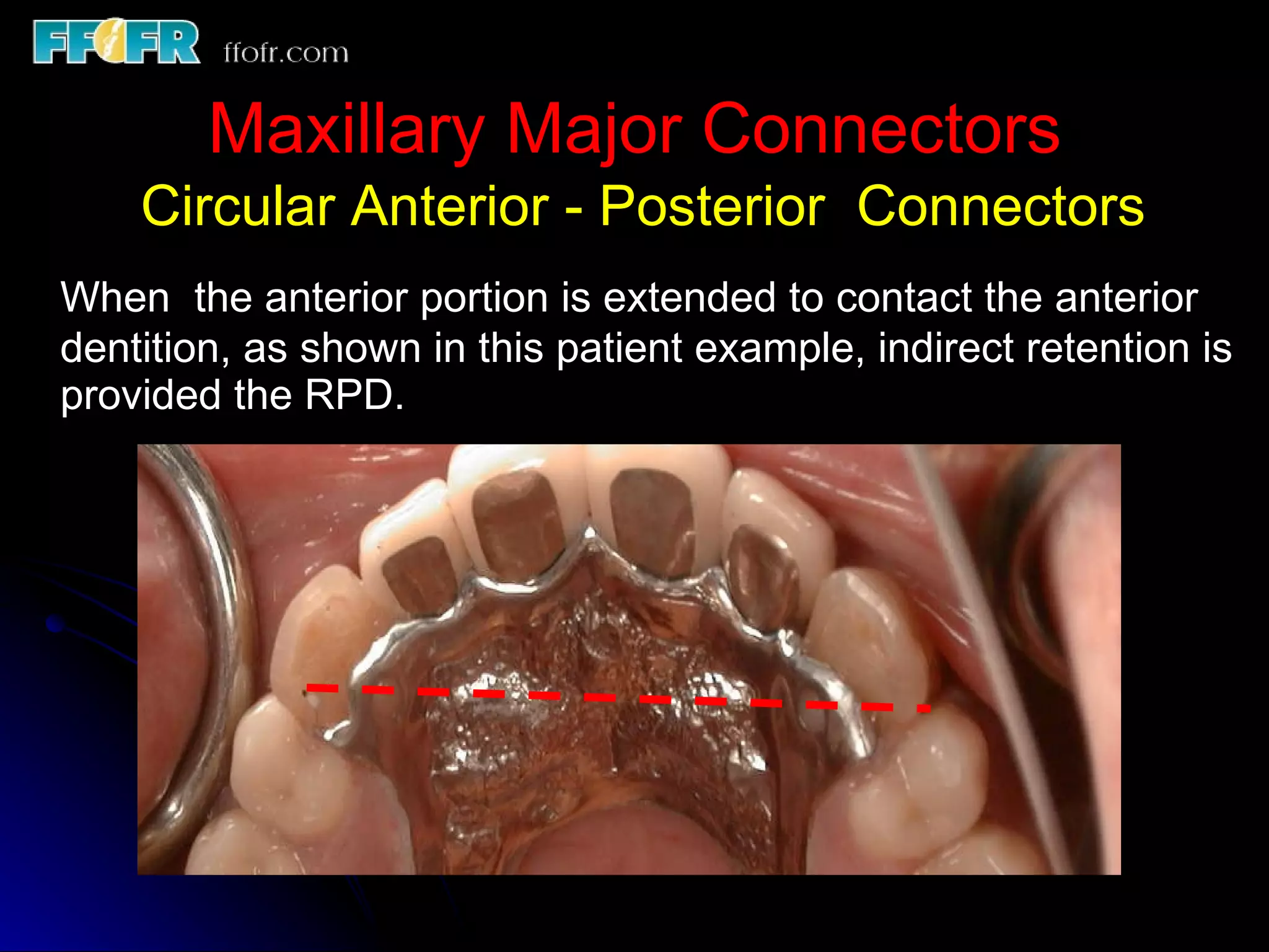 Tooth tissue junction, major and minor connectors | PPT