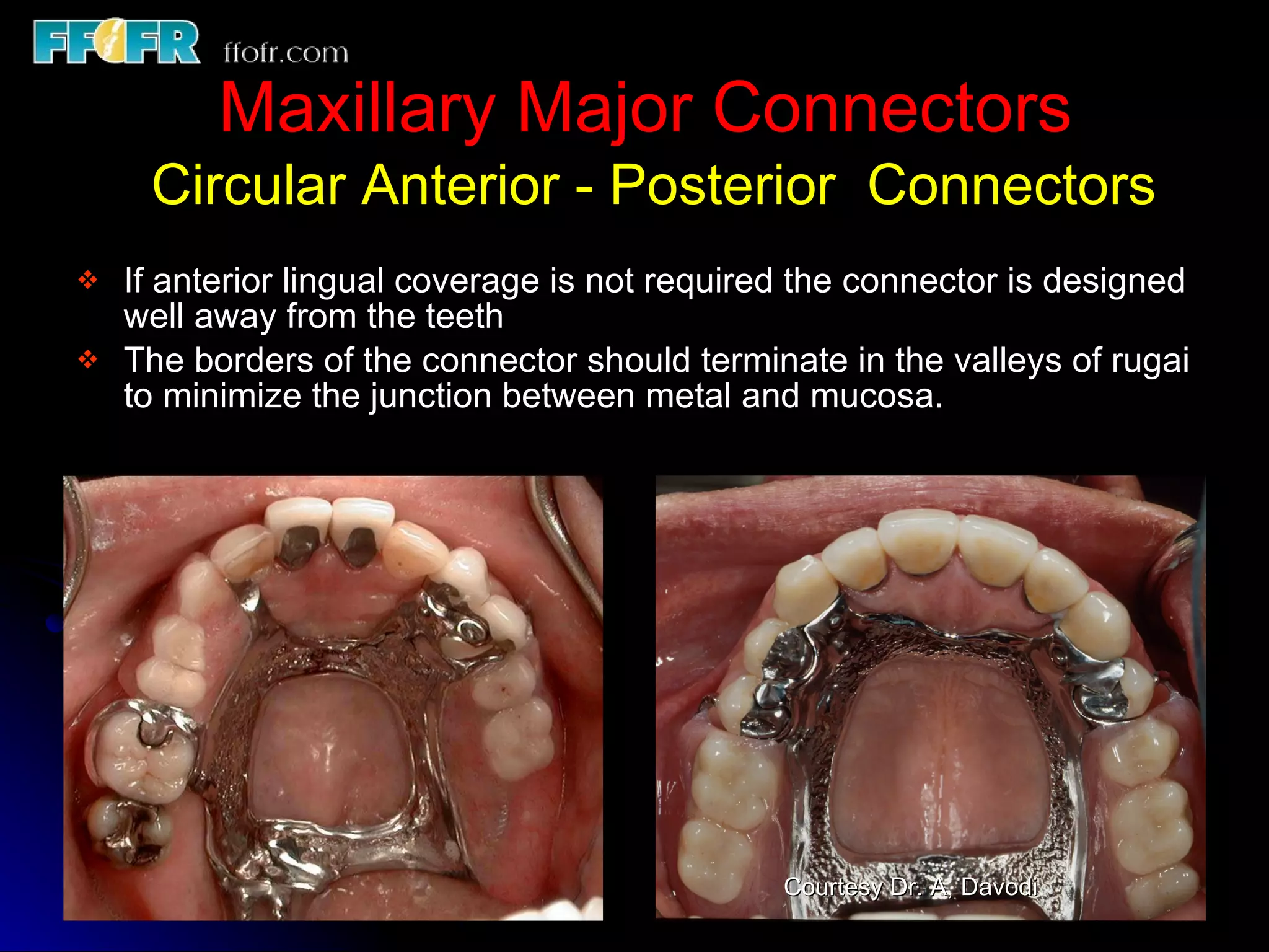 Tooth tissue junction, major and minor connectors | PPT
