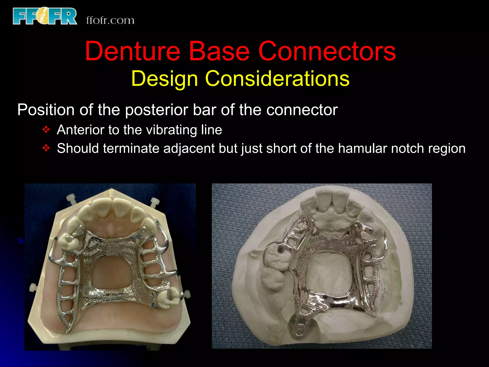 Tooth tissue junction, major and minor connectors | PPT