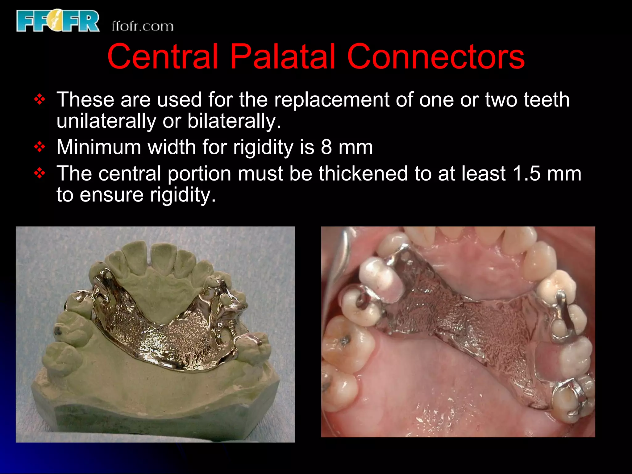 Tooth tissue junction, major and minor connectors | PPT