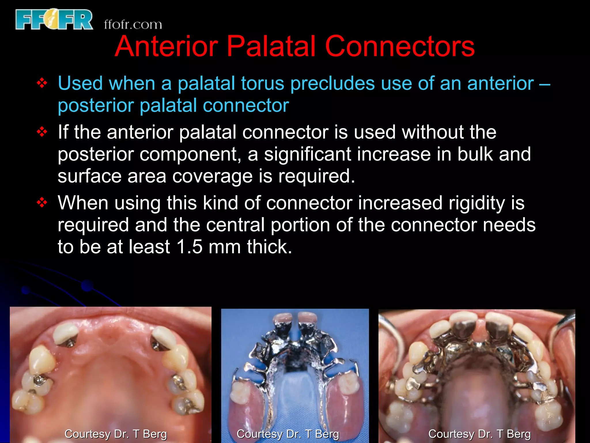Tooth tissue junction, major and minor connectors | PPT