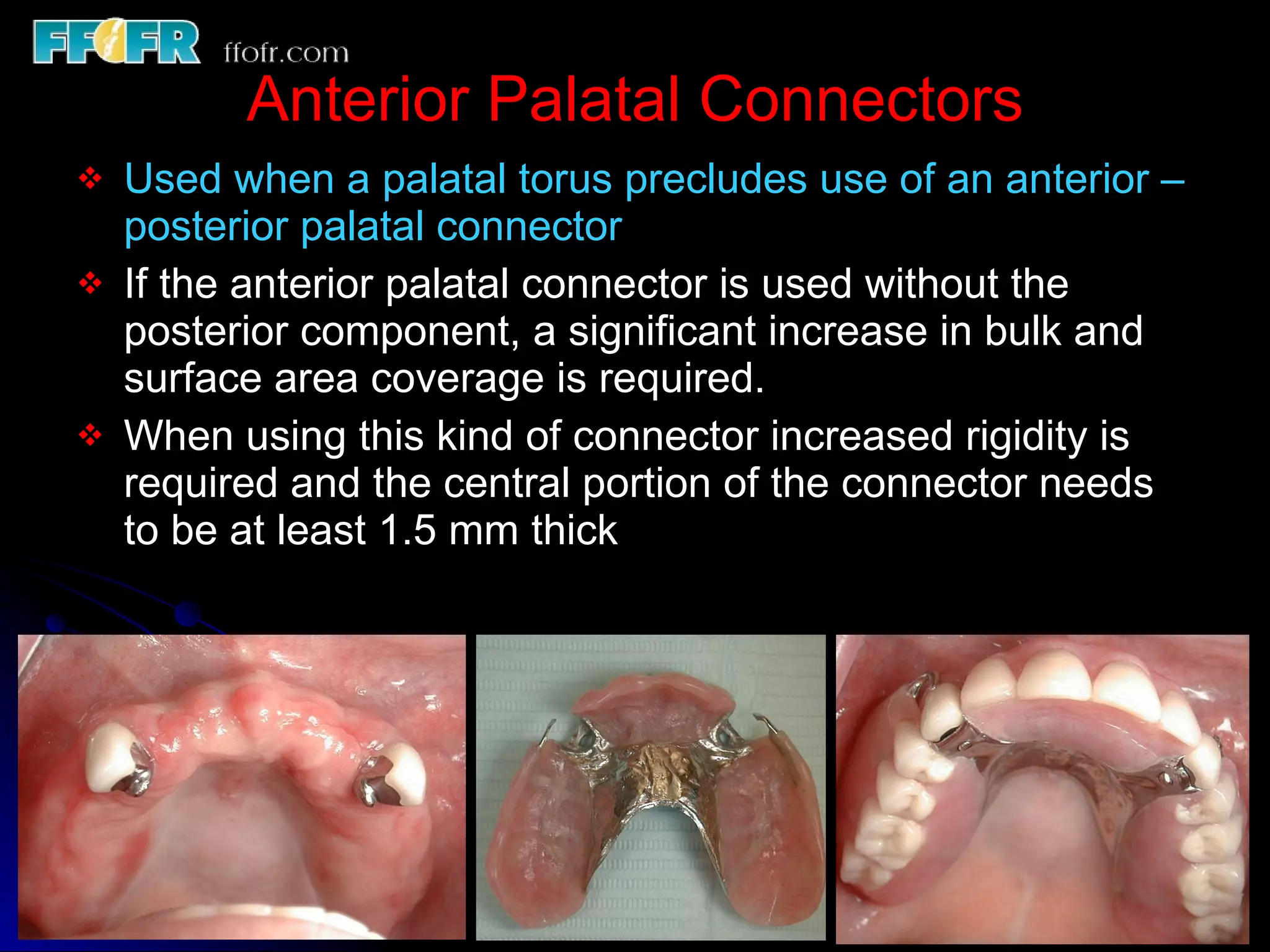 Tooth tissue junction, major and minor connectors | PPT