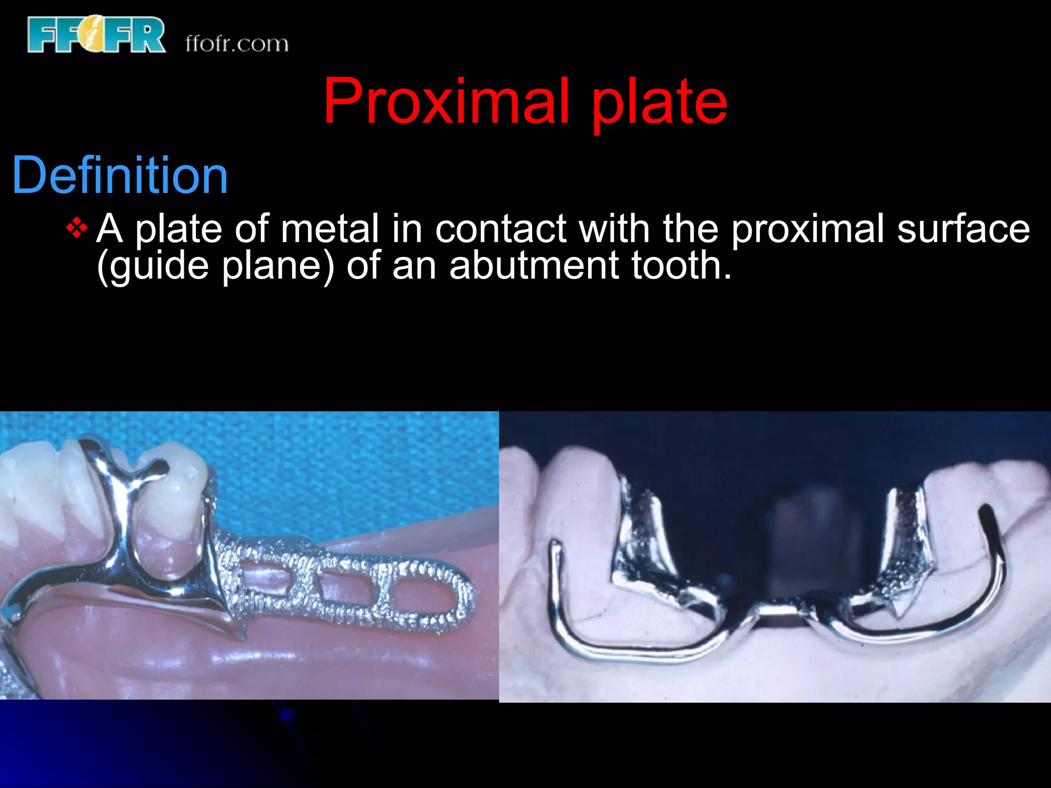 Tooth tissue junction, major and minor connectors | PPT