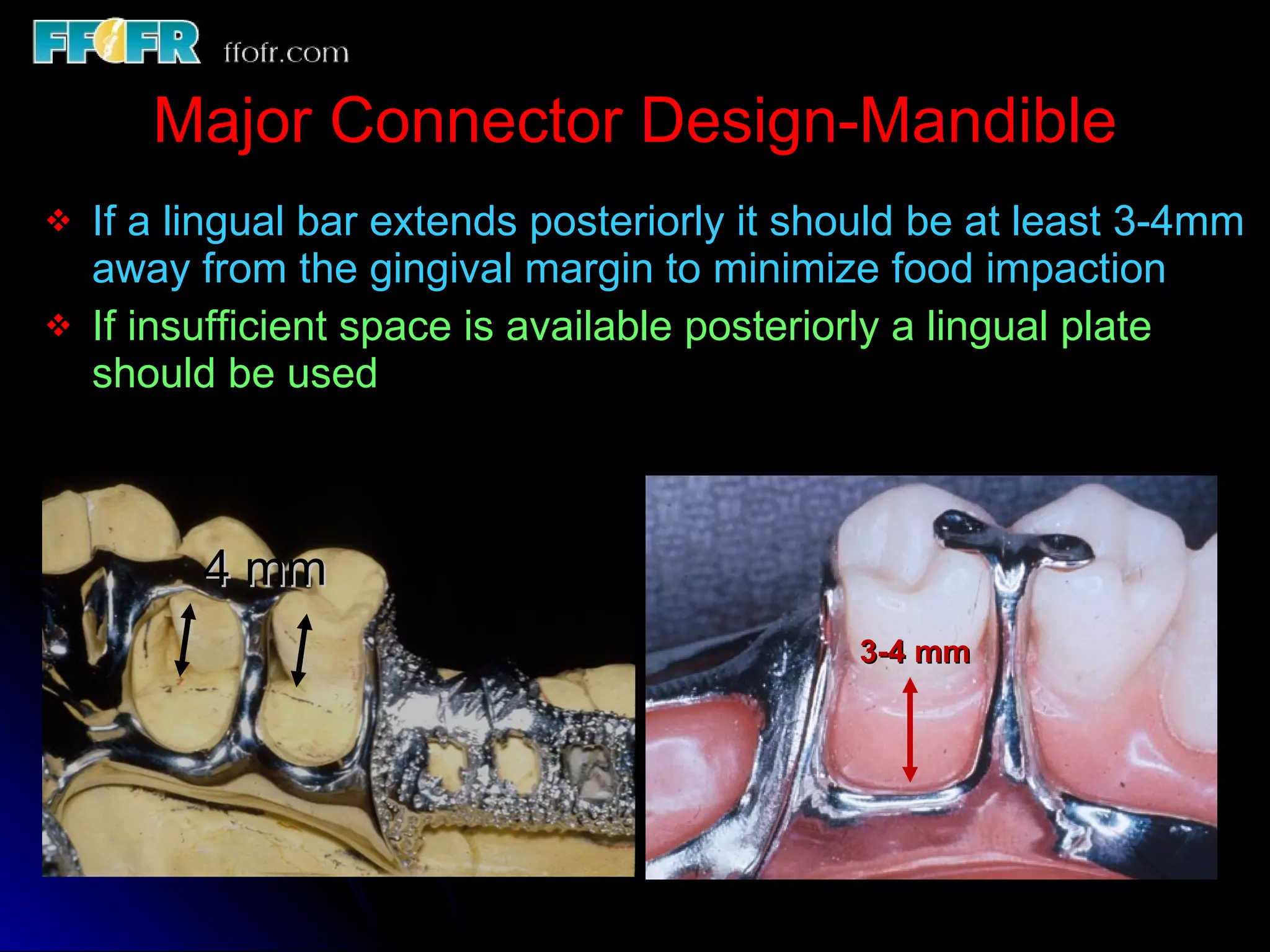 Tooth tissue junction, major and minor connectors | PPT