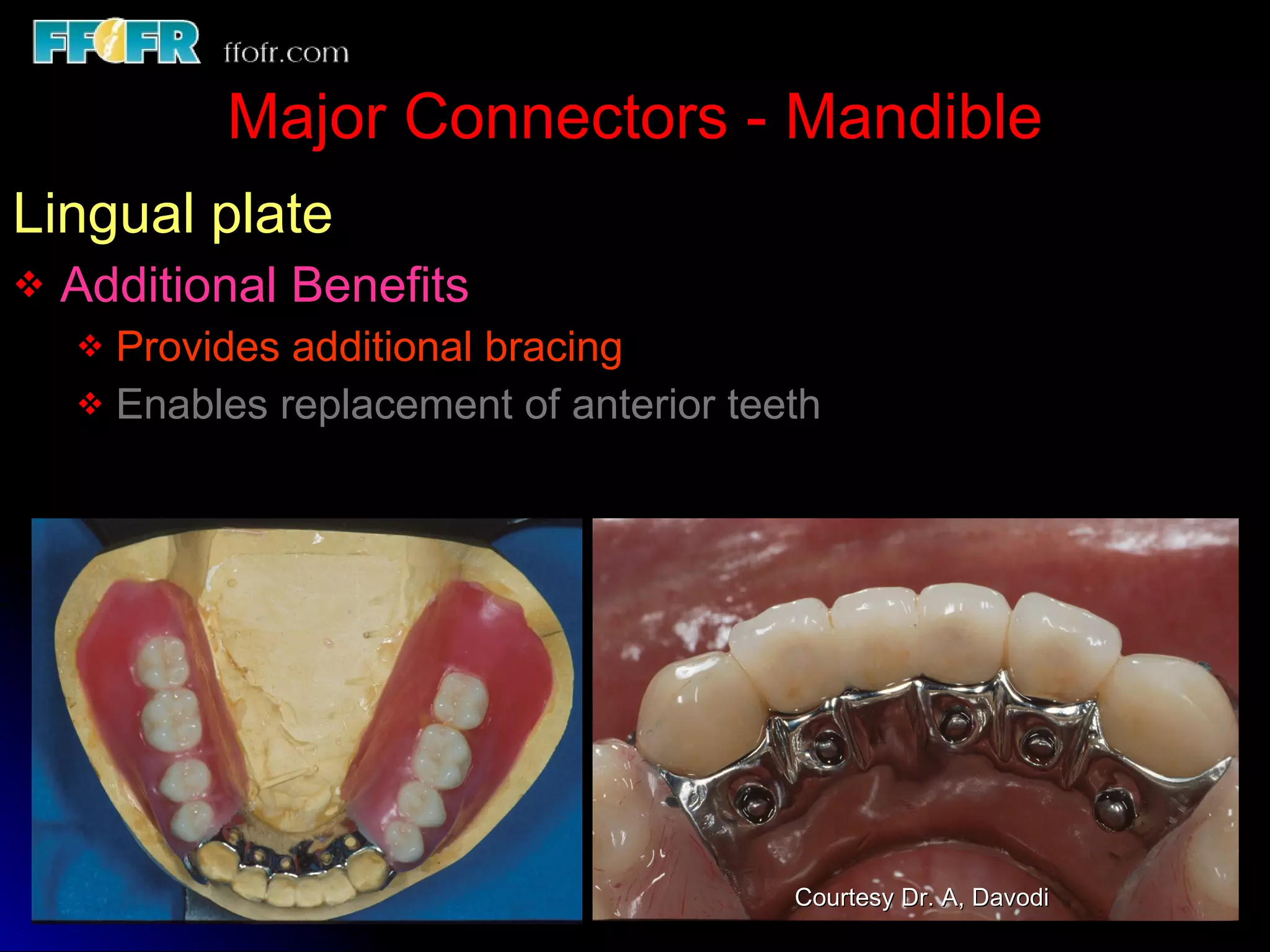 Tooth tissue junction, major and minor connectors | PPT