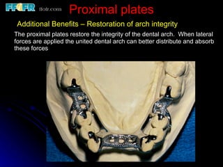 Tooth tissue junction, major and minor connectors | PPT