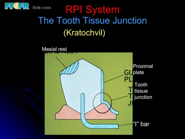 Tooth tissue junction, major and minor connectors | PPT