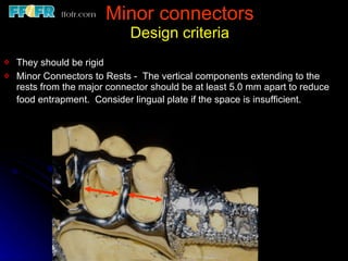 Tooth tissue junction, major and minor connectors | PPT