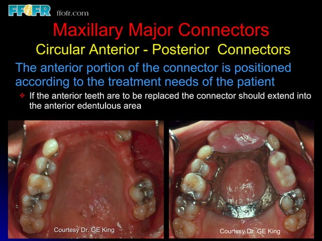 Tooth tissue junction, major and minor connectors | PPT