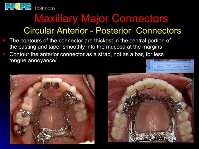 Tooth tissue junction, major and minor connectors | PPT