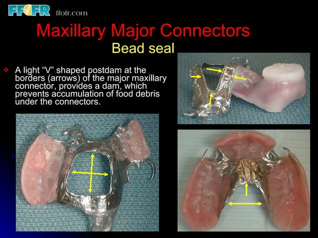 Tooth tissue junction, major and minor connectors | PPT