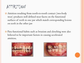 Tooth wear and its types | PPTX