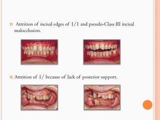Tooth wear and its types | PPTX