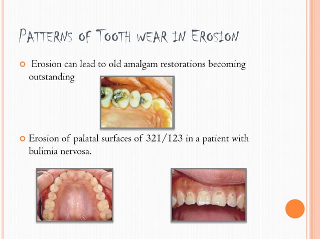 Tooth wear and its types