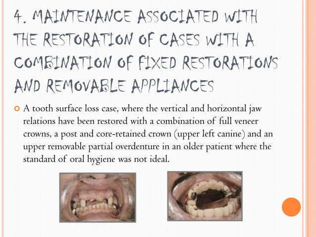 Tooth wear and its types