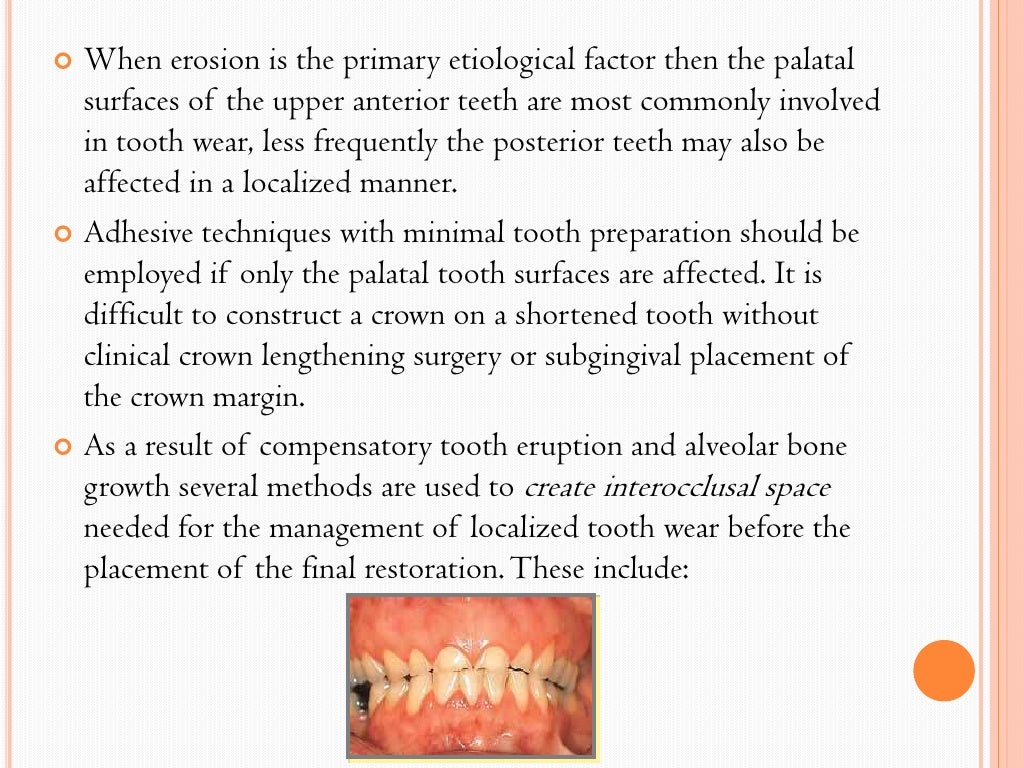 Tooth wear and its types