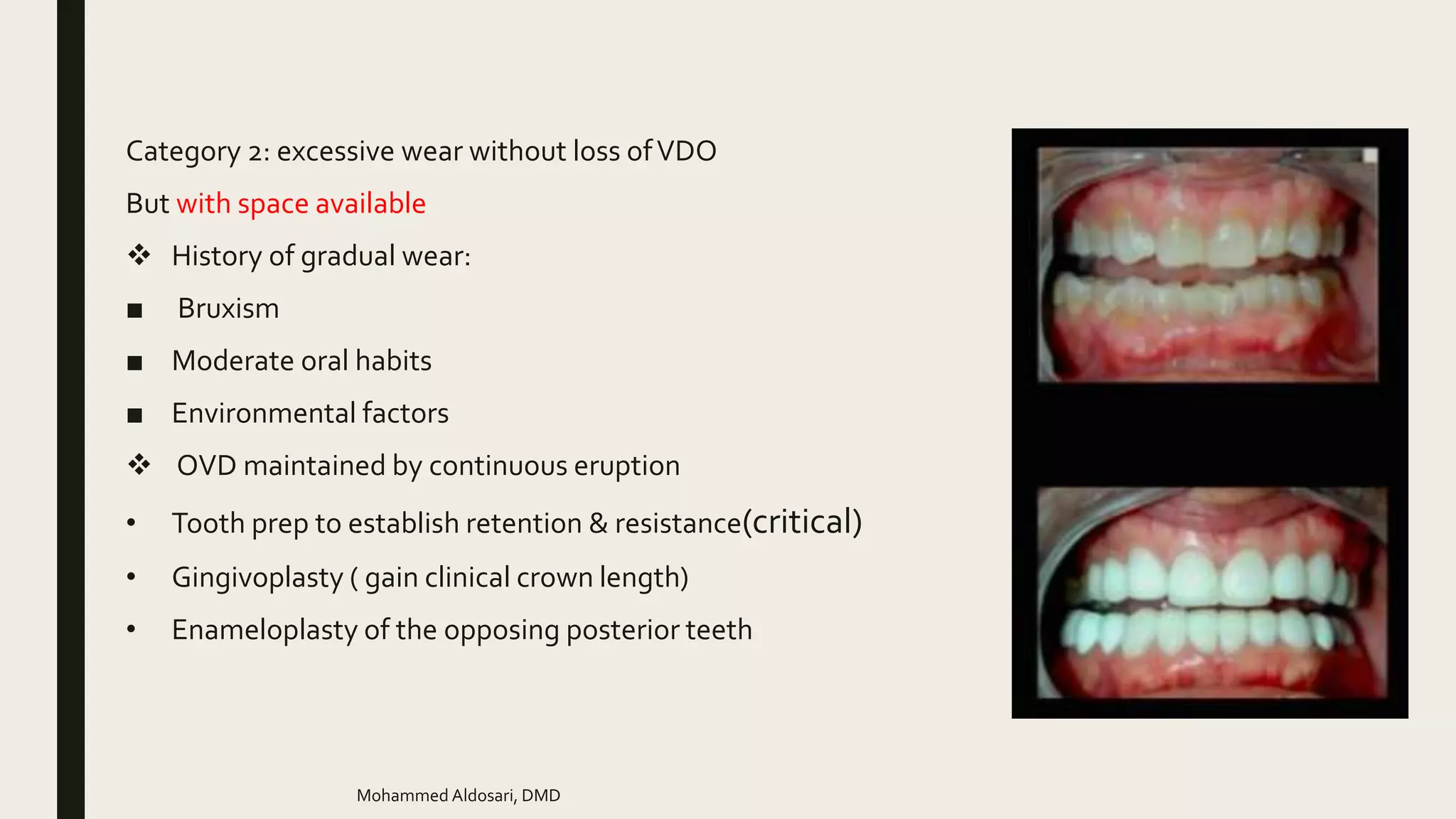 Tooth wear final | PPTX