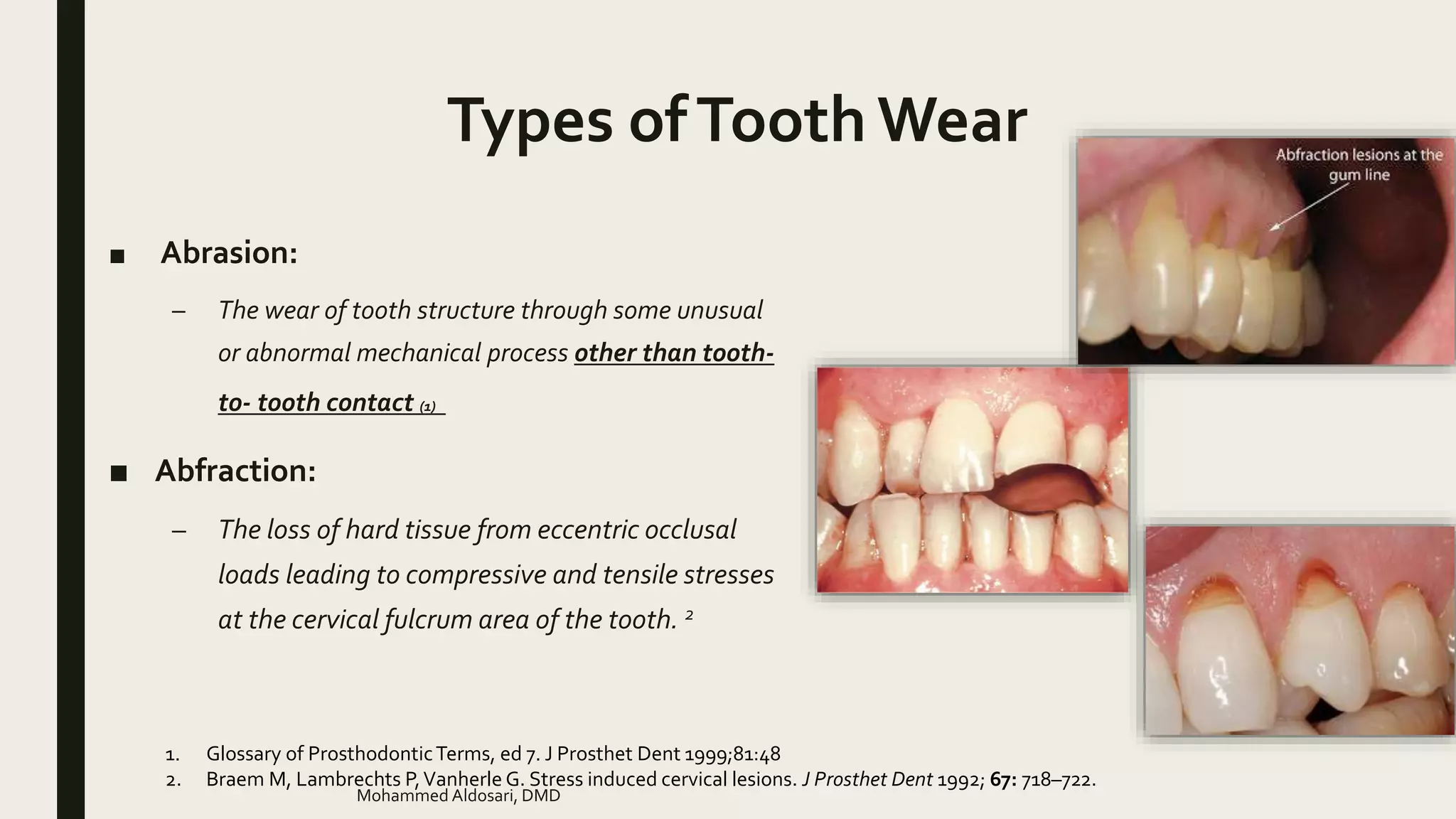 Tooth wear final | PPTX