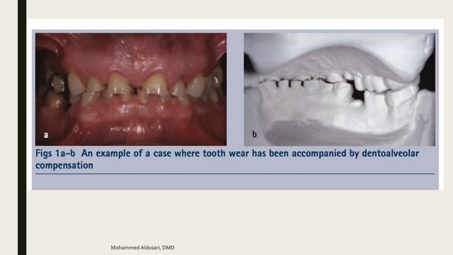 Tooth wear final | PPTX | Dental Health | Diseases and Conditions