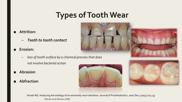 Tooth wear final | PPTX | Dental Health | Diseases and Conditions