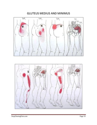 Gluteus Medius Trigger Points
