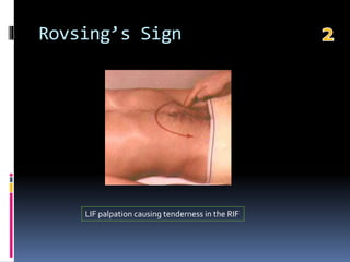 Rovsing Sign
