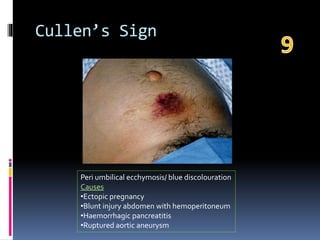 Periumbilical Cullen Sign