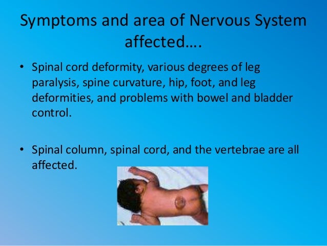 Top 3 Causes And Symptoms Of Spina Bifida
