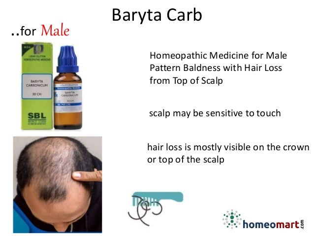 Top 5 Hair Loss Medicines In Homeopathy For Male And Female Pattern Bal…