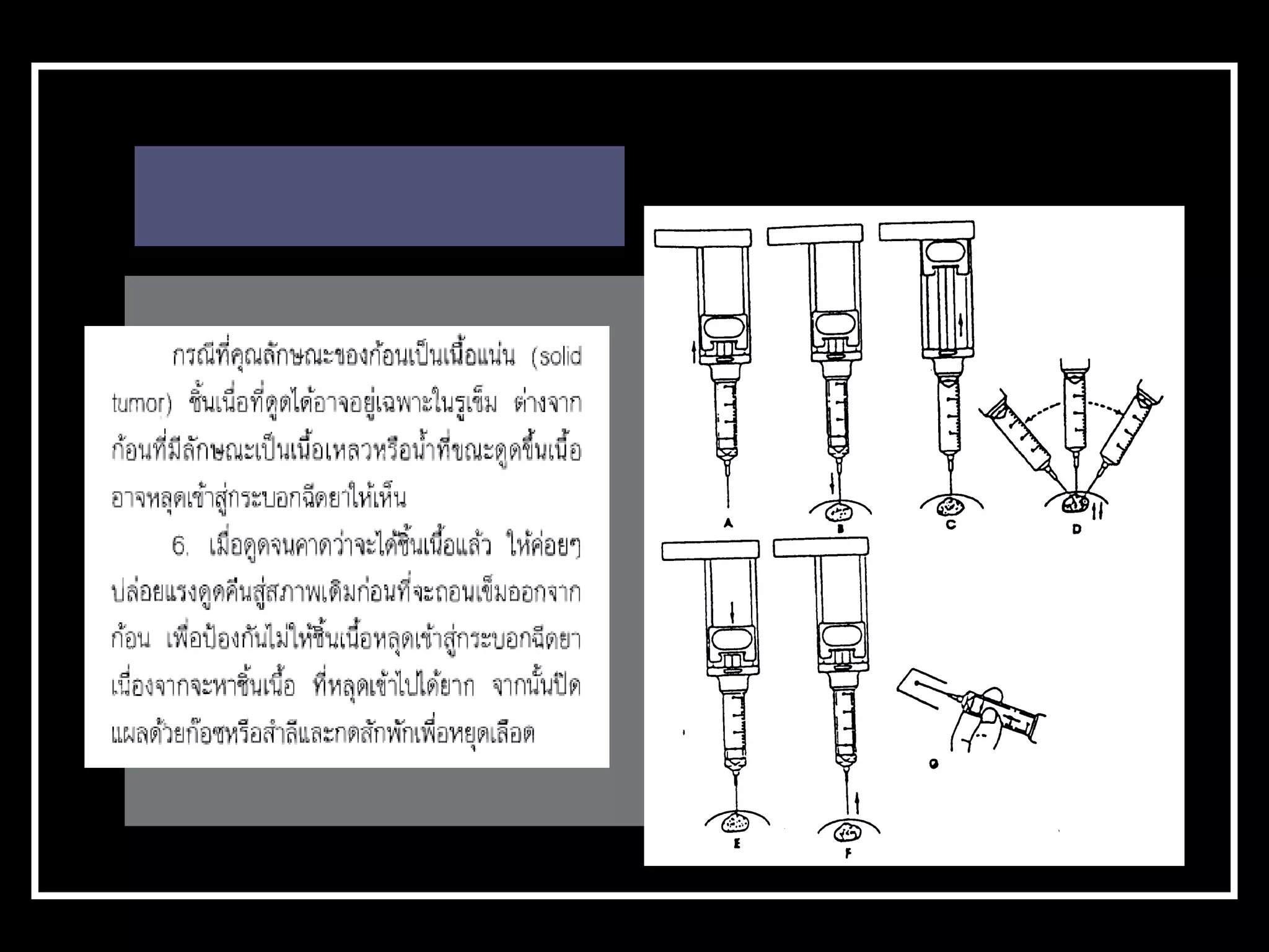 Solitary Thyroid Nodule Ppt