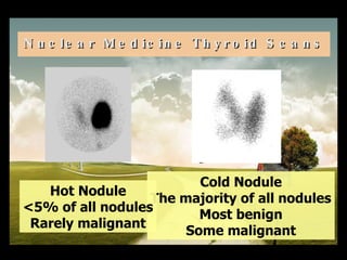 solitary thyroid nodule | PPT