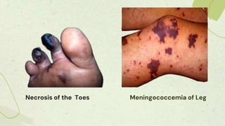 Topic - DIC ( .Disseminated intravascular coagulation)pptx | PPTX