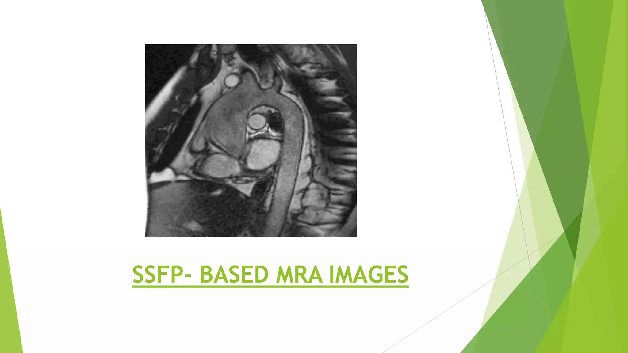 magnetic resonance in angiography | PPTX