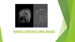 magnetic resonance in angiography | PPTX