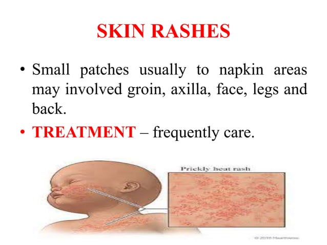 Topic Minor Disorders Of The Newborn Ppt